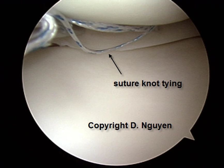 Meniscus Surgery | Nguyen Sports Medicine