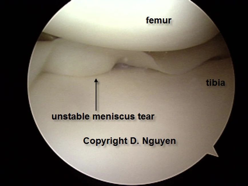 Meniscus Surgery | Nguyen Sports Medicine