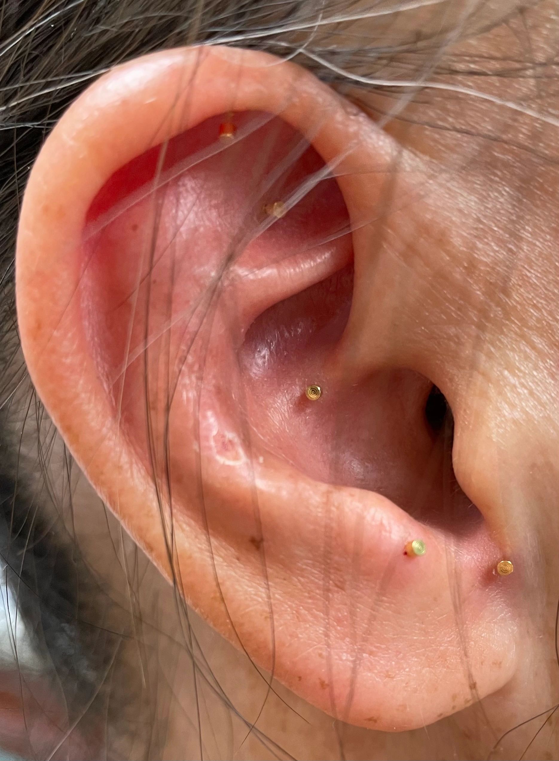 Auricular Acupuncture: Healing the Heroes in U.S. Military Clinic ...