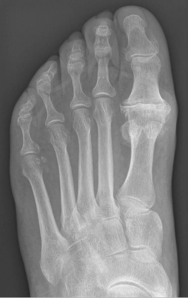 Great Toe Arthritis (Hallux Rigidus)