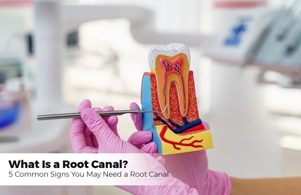 What Is a Root Canal? 5 Common Signs You May Need a Root Canal