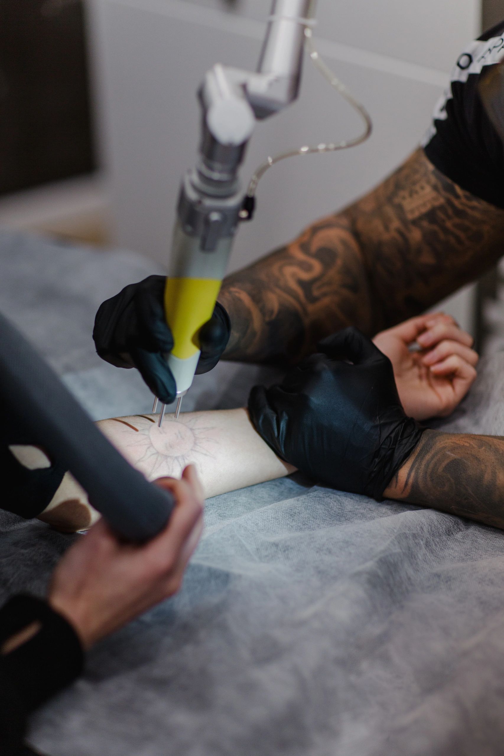 Laser Tattoo Removal Canberra - Advanced Tattoo Removals!