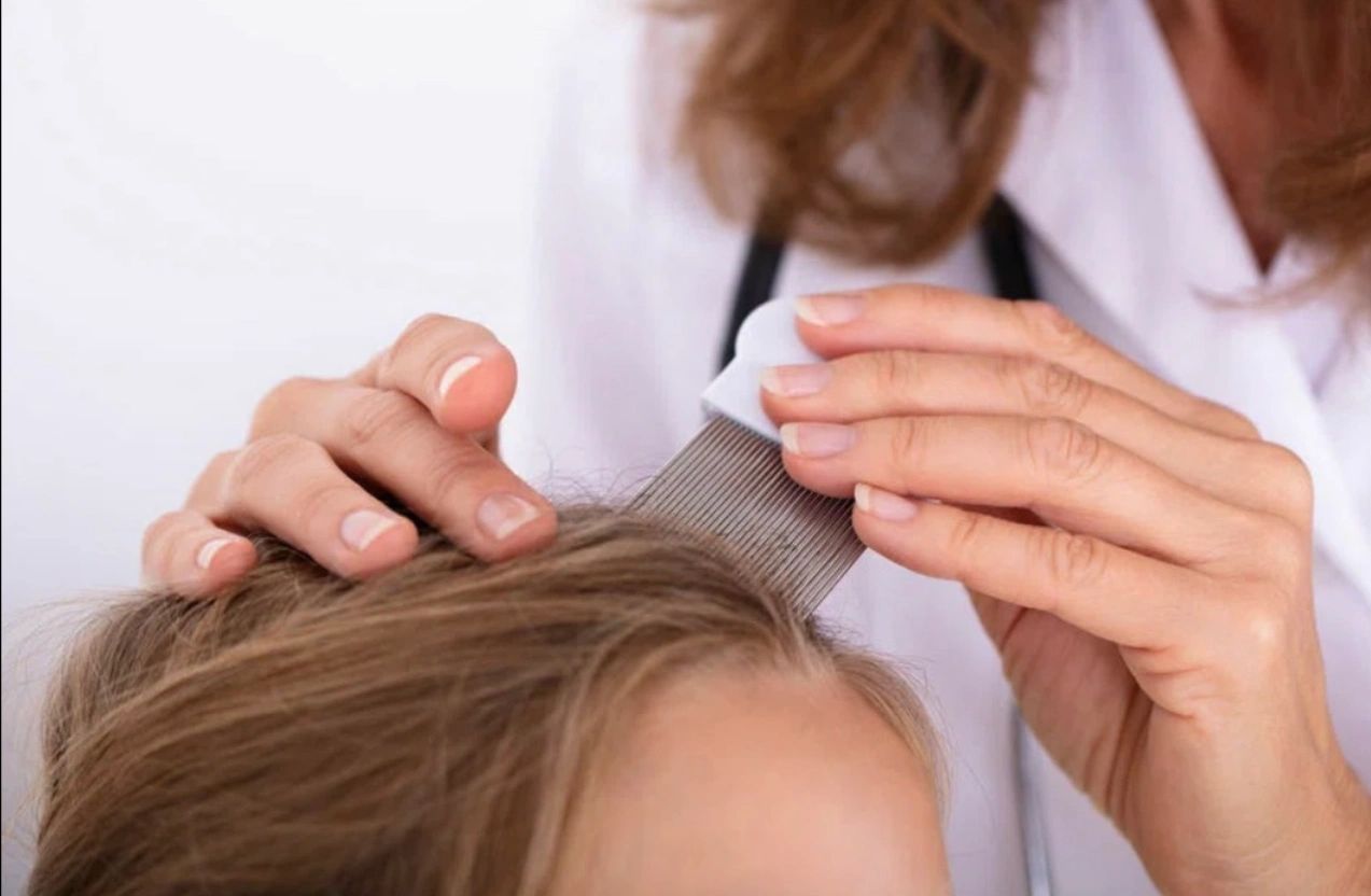 Full Lice Removal, Lice Treatment Service Clinics in Anaheim
