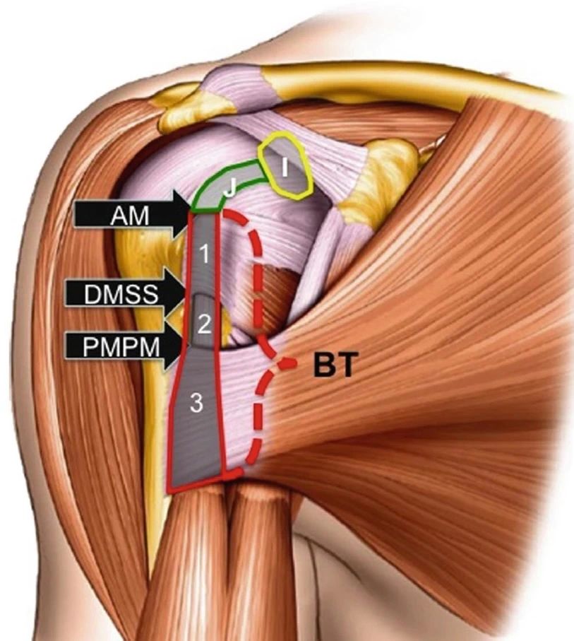 肱二頭肌長頭近端肌腱-上關節唇病變 ( bicipital-labral complex)