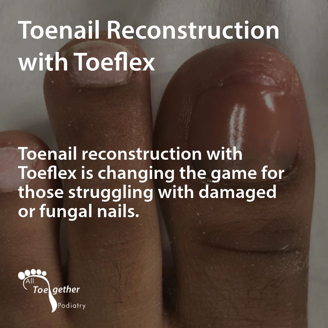 Toenail Reconstruction with Toeflex