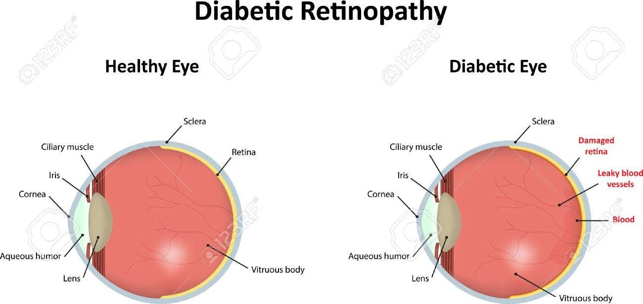 What is Diabetic Retinopathy?