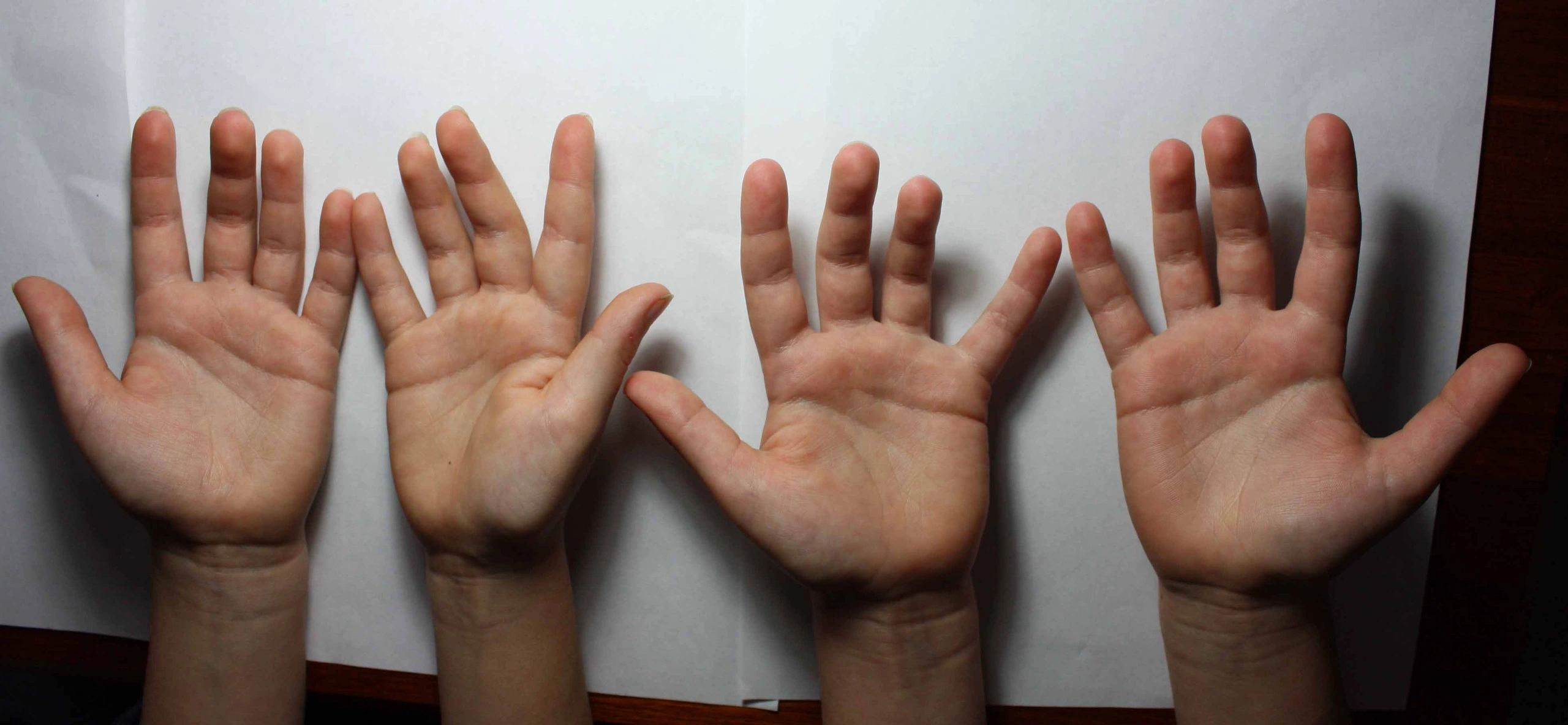 Are the palm lines of identical and un-identical twins the same?