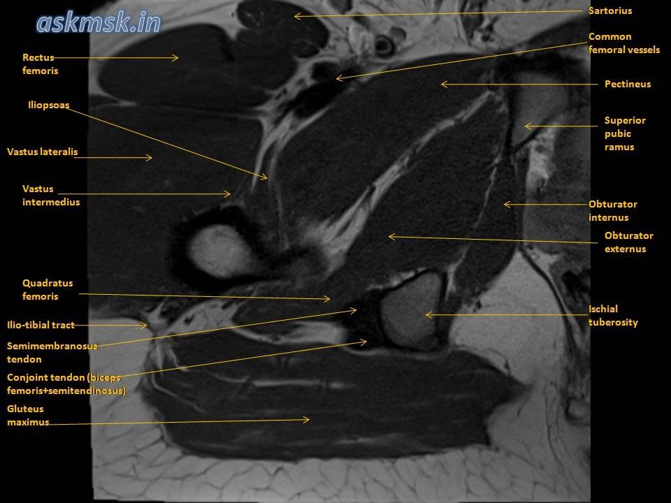 Obturator Internus Mri