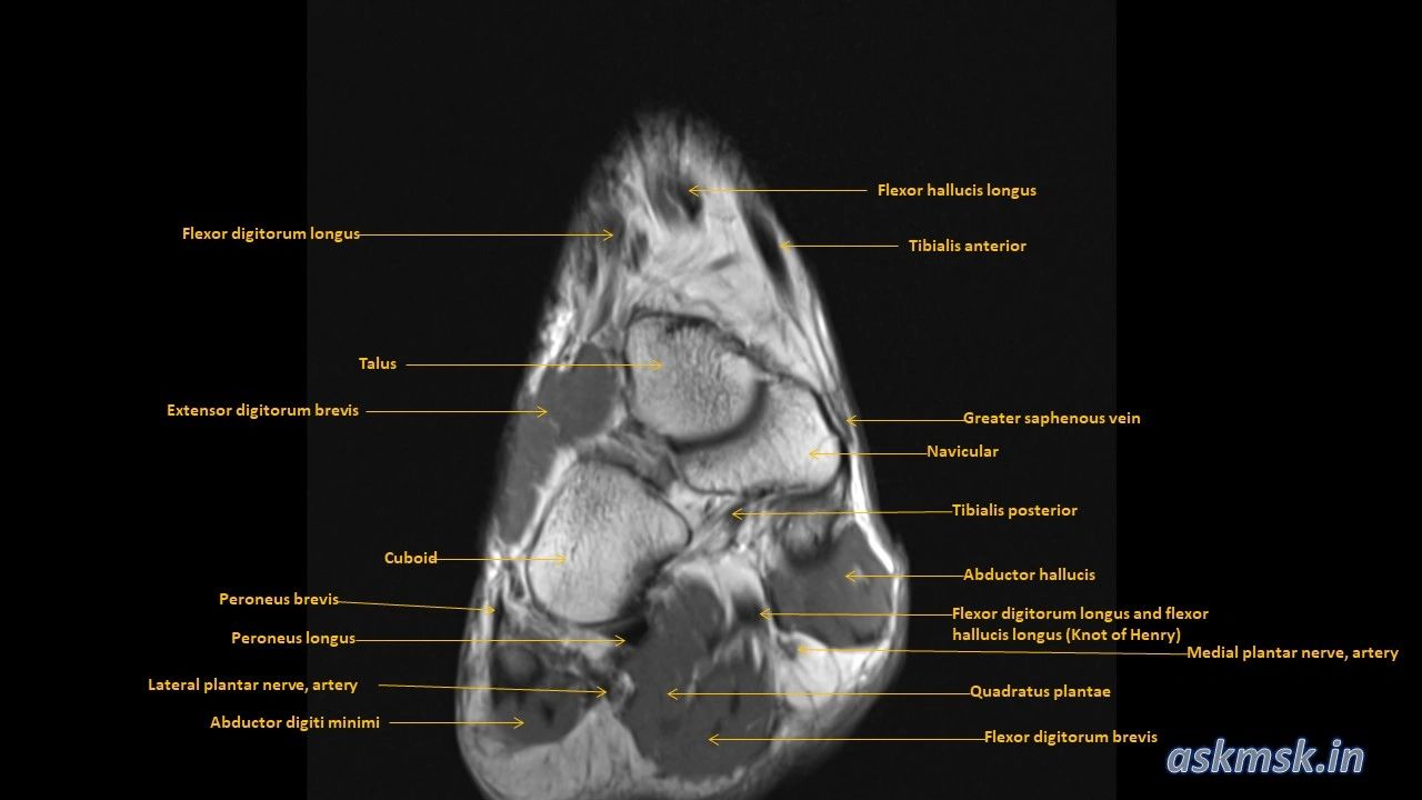 Extensor Digitorum Brevis Mri