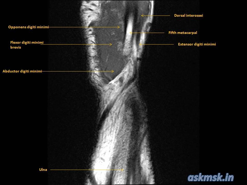 Abductor Digiti Minimi Mri
