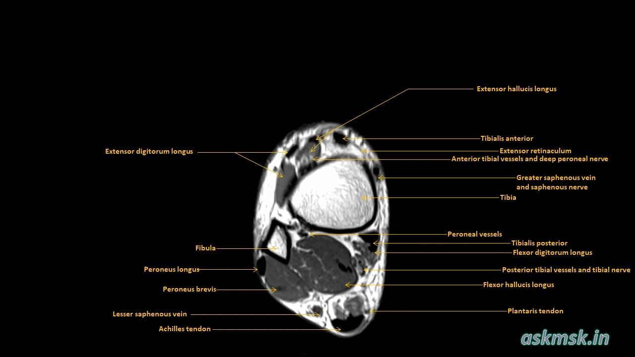 Tibialis Anterior Tendon Mri