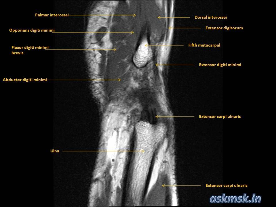 Abductor Digiti Minimi Mri