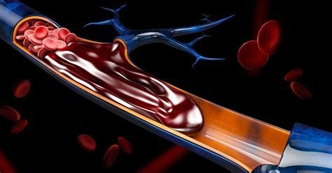 VTE Explained: Retriever Medical’s Clot Management Innovations