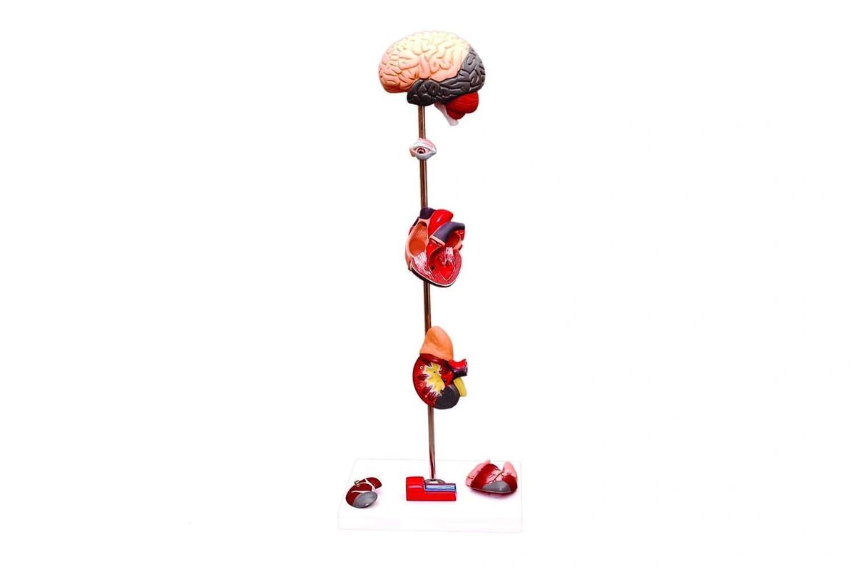 Hypertension model