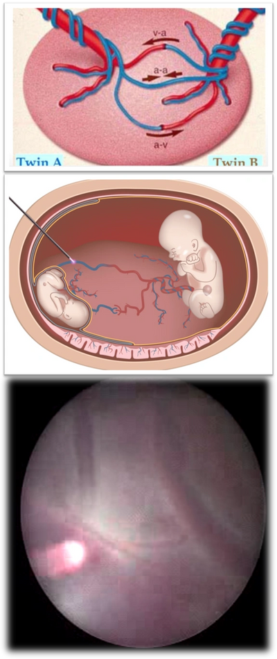 Fetal therapy | Chennai Fetal Care