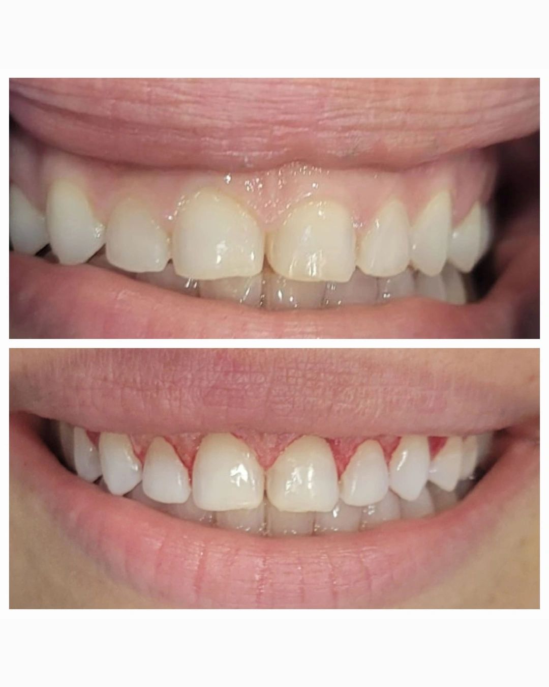 Gingivectomy: A Smile Transformation for Enhanced Oral Health