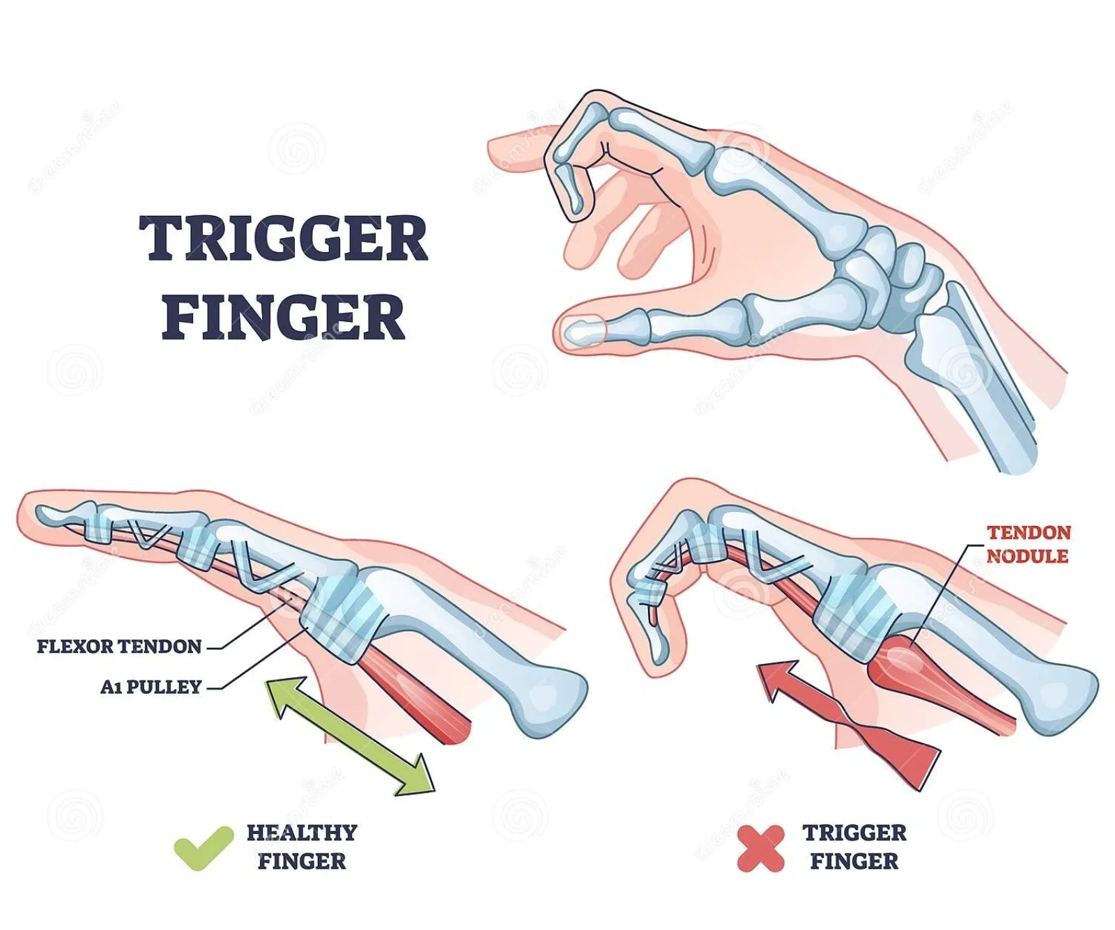 Finger on the Trigger: Understanding and Treating Trigger Finger