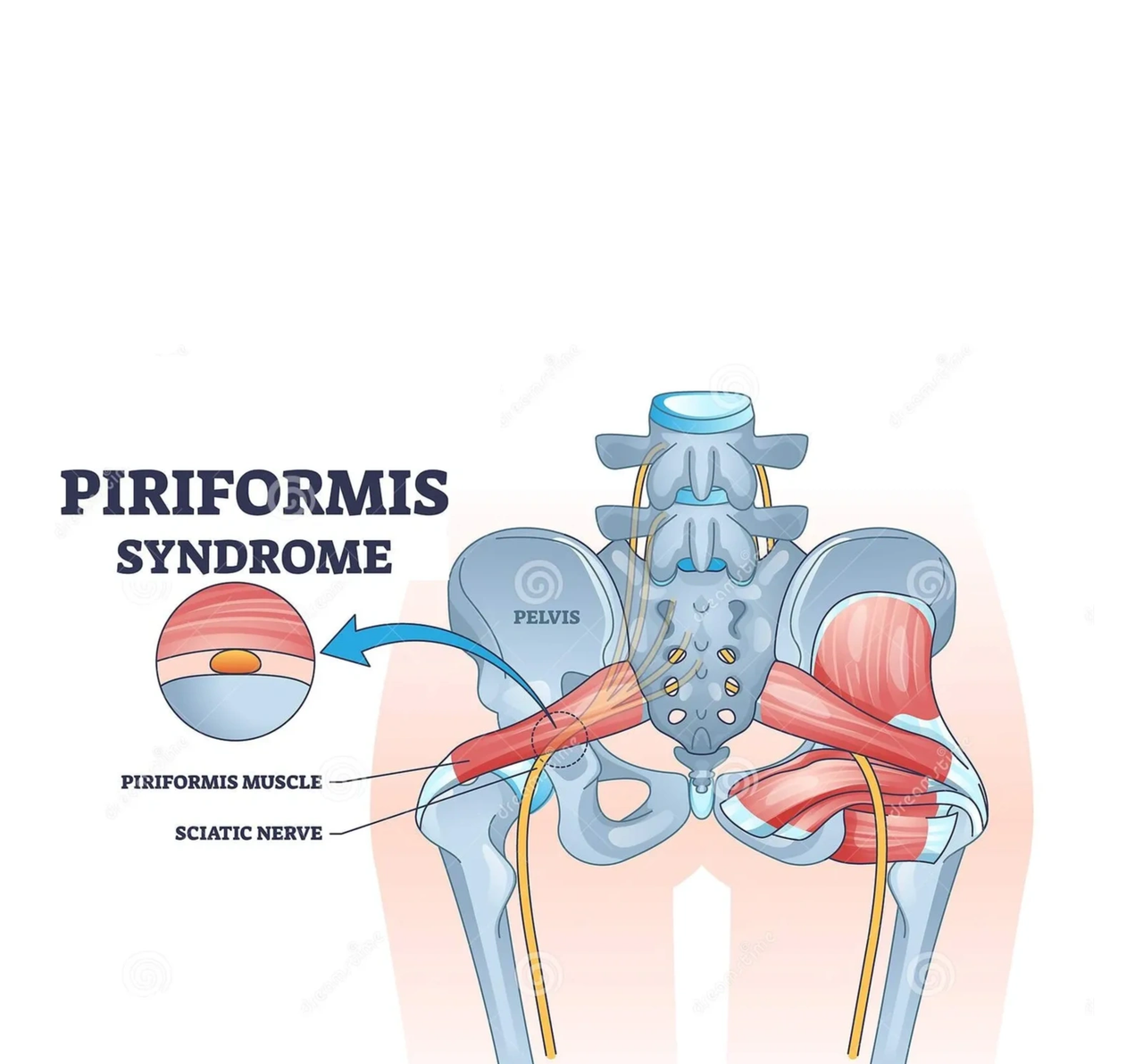 Piriformis Syndrome Highlighted Piriformis The Doctors Condition Of