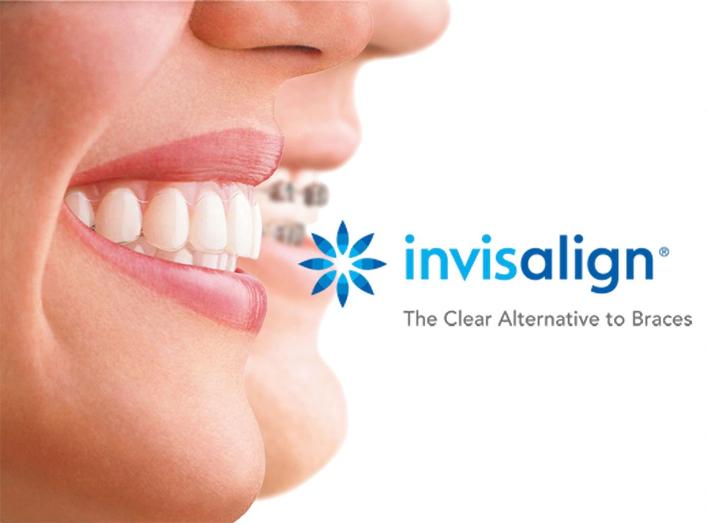 Invisalign Consultation