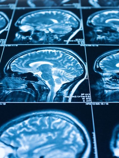 Movement Disorders - North Texas Movement Disorders Institute Inc