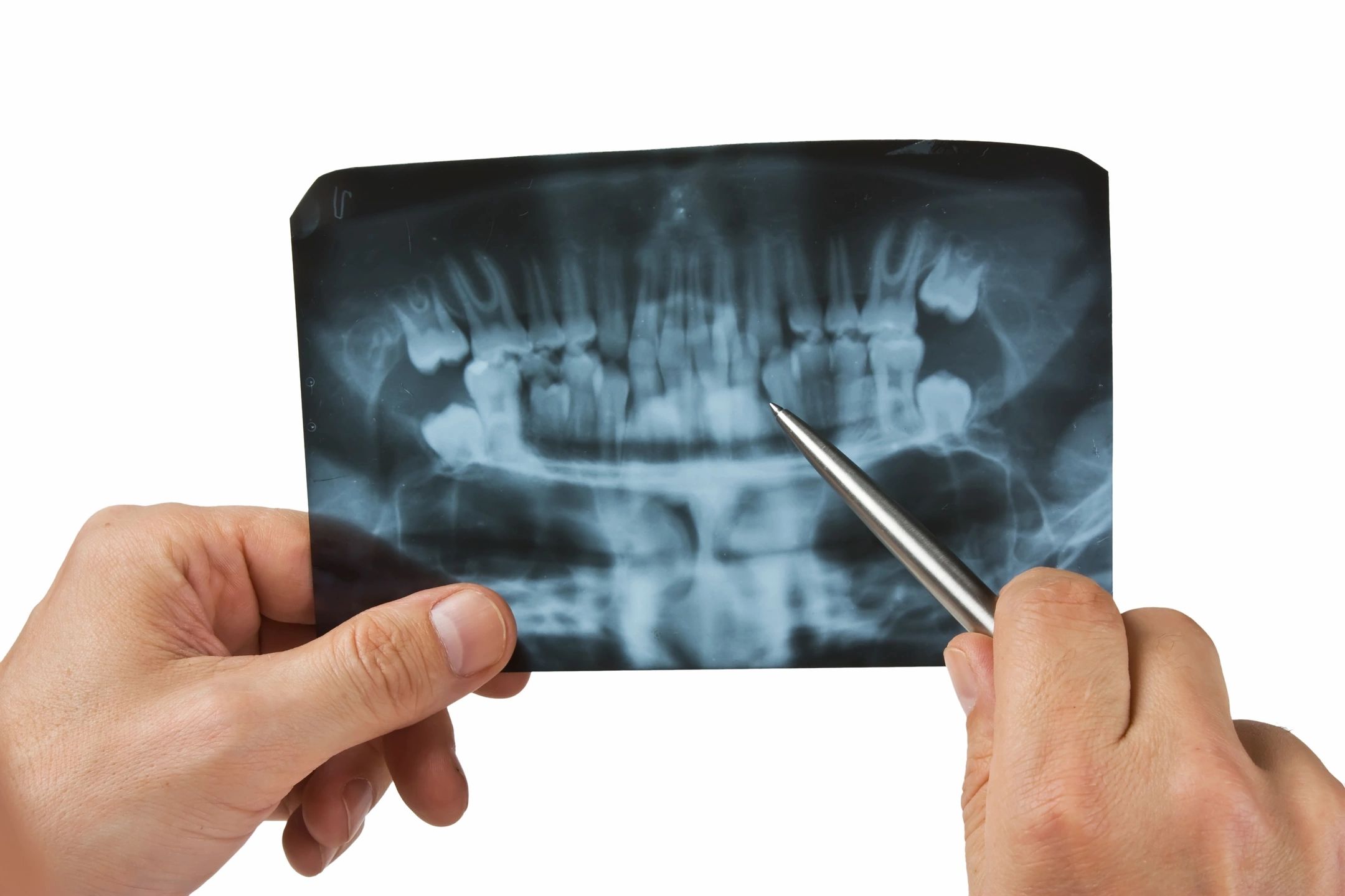 The Importance of Bone Graft After Tooth Extraction